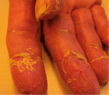 Symptoms & Stages - Hand-foot Syndrome